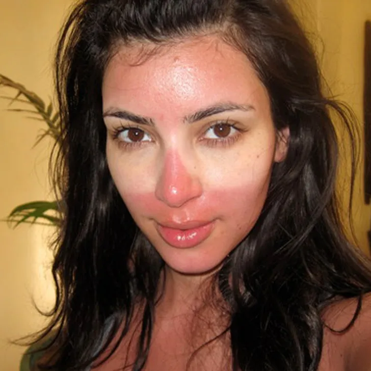 6 Tips to Help You Treat a Sunburn – Cairo 360 Guide to Cairo, Egypt